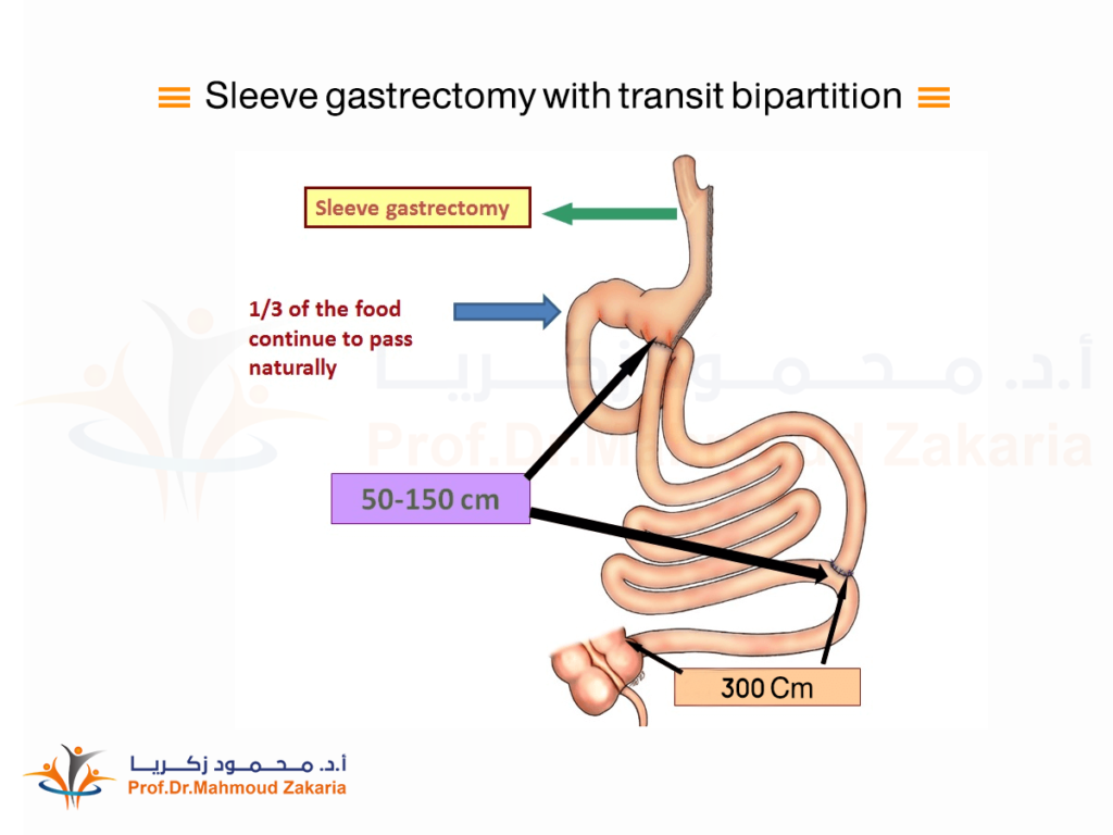 Dual division sleeve for weight loss |prof.Mahmoud zakaria